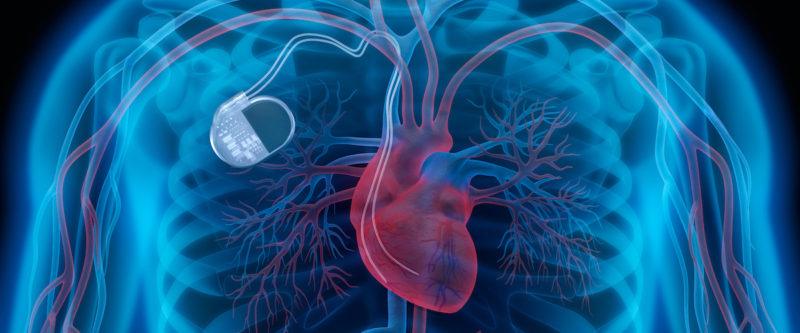 Pacemaker Implantation – CardioVSurgical